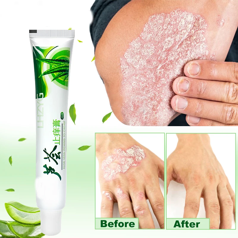 Psoriasis-Cream-Treatment-Dermatitis-Eczema-Skin-Care-Medical-Cream ...