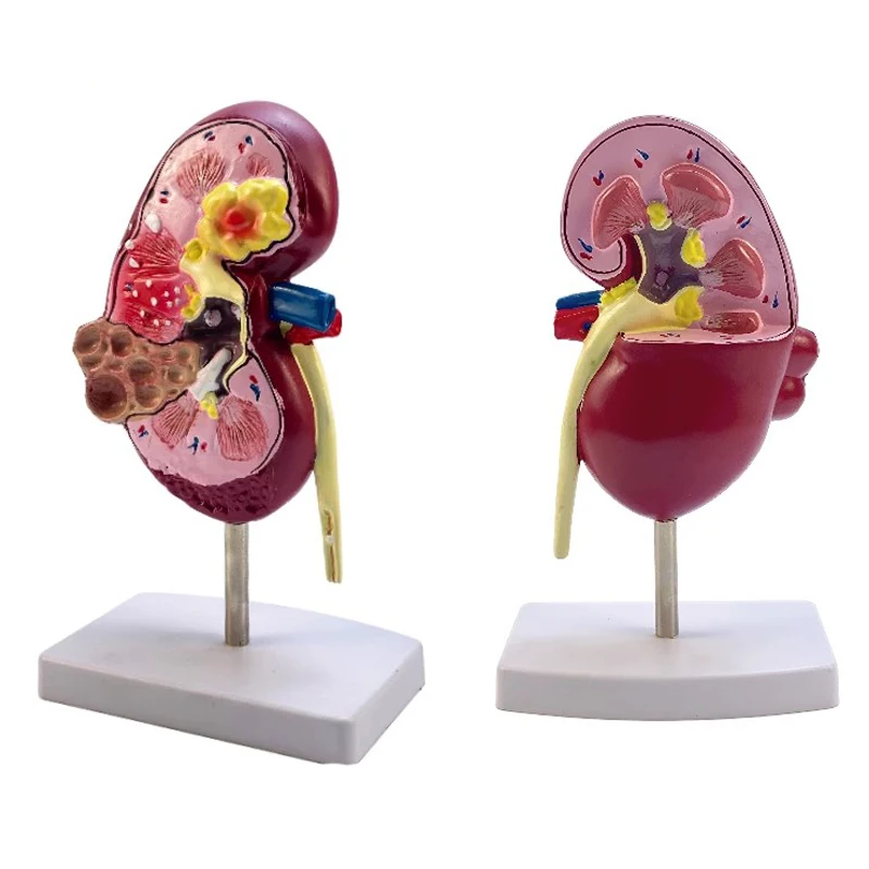 Life-Size-Kidney-Pathologies-Model-Human-Body-Anatomy-Replica-of ...