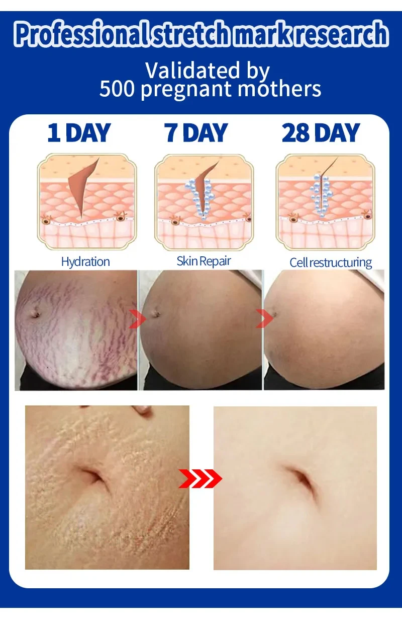 Stretch Marks Permanent Removal Cream - UNIQ