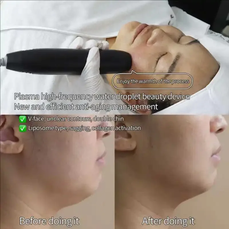 2026 Skin Rejuvenation Cold Plasma Device Fractional Cold Warm Plasma ...