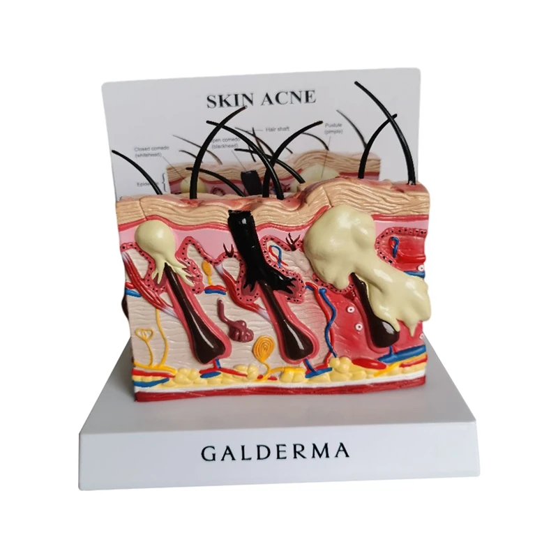 Skin-Acne-Model-Anatomy-Model-Human-Anatomy-Normal-And-Common-Acne-Skin ...