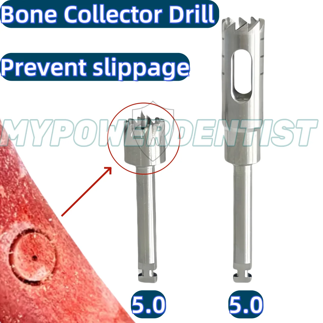 Dental Bone Collector Drill Pre-Hole Anti-Slip Harvest Hole Locator ...