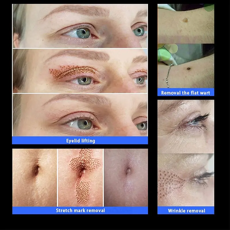 Filiform Wart On Eyelid