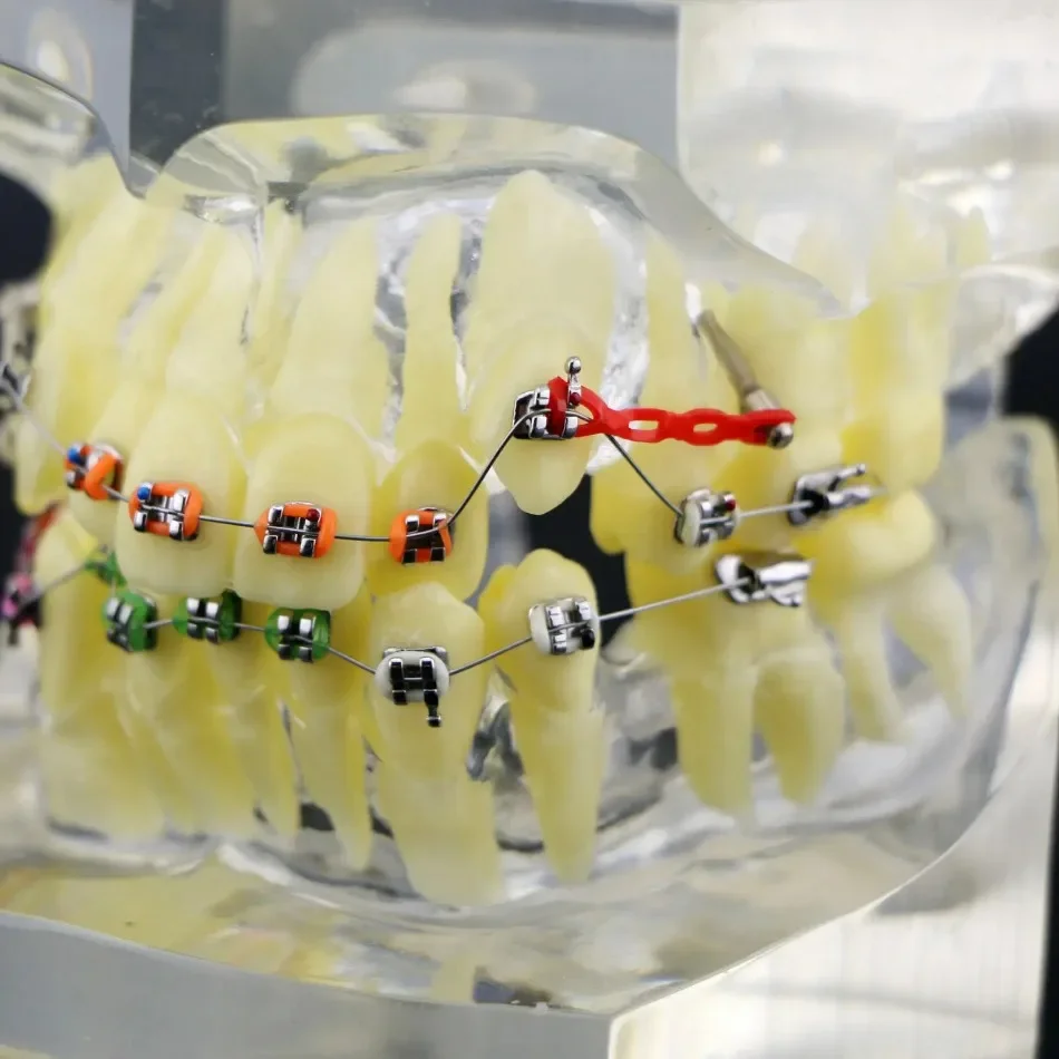 Dental-Orthodontic-Teeth-Model-Chain-Brackets-Demonstrate-Treatment-Jaw ...