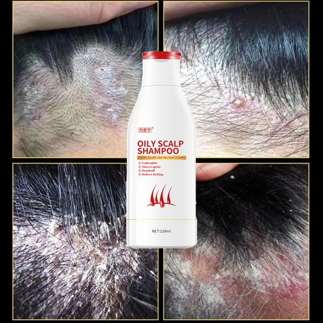 Psoriasis Scalp Shampoo