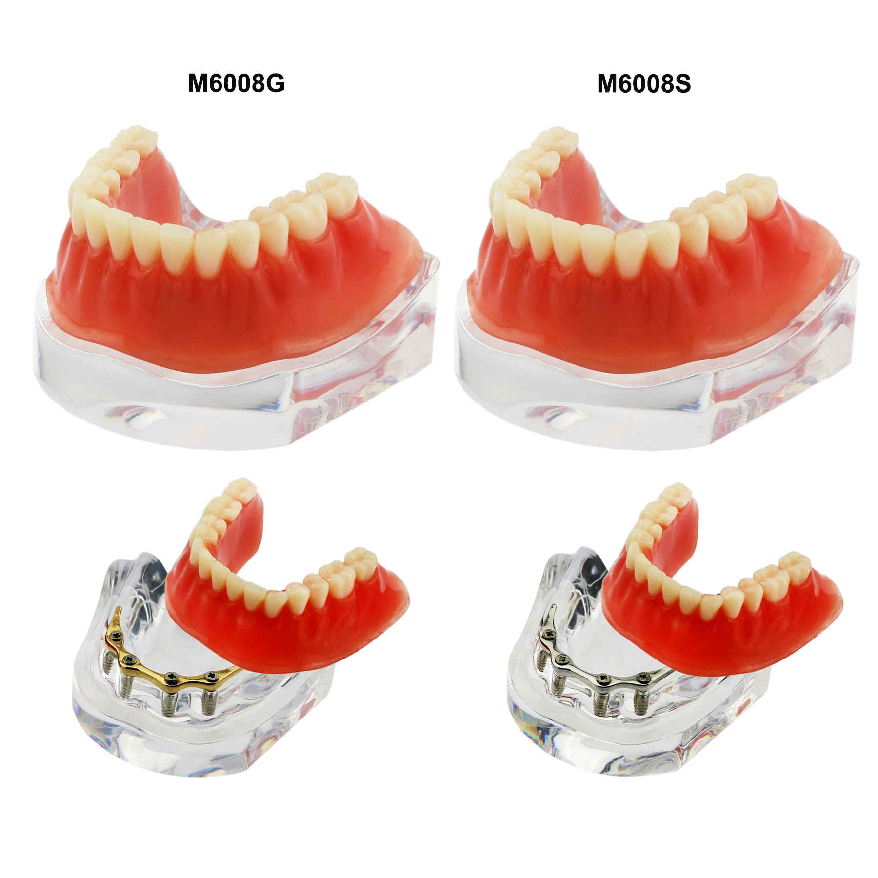 Dental Removable Overdenture Teeth Model Lower Jaw 4 Precision Implants ...