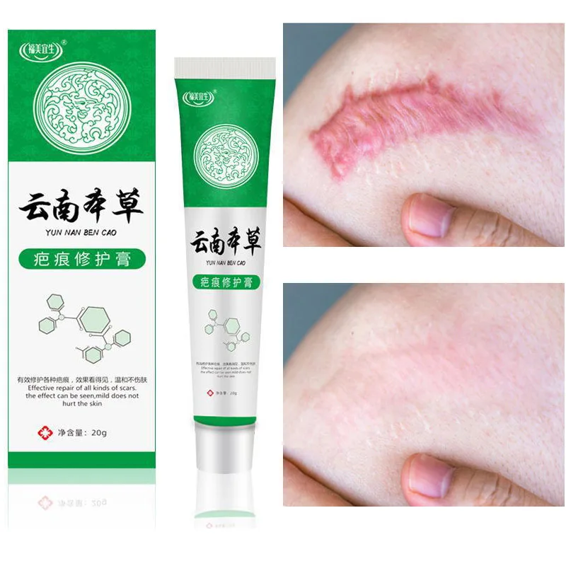 20g-Herbal-Scar-Removal-Cream-Gel-Repairing-Pock-Stretch-Mark-Burn ...