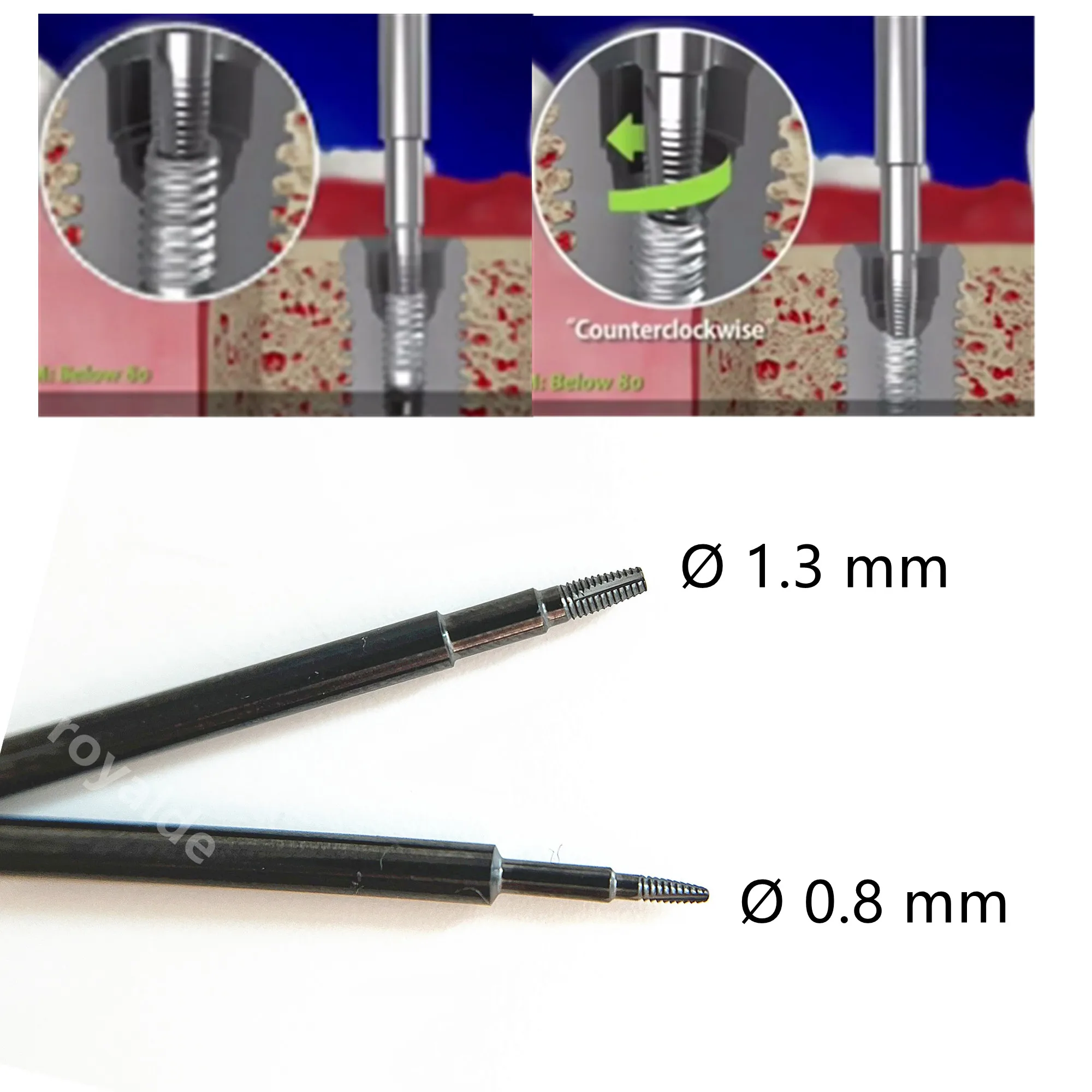 Implant Fixture Fractured Broken Screws Removal SOS Remove Tap ...