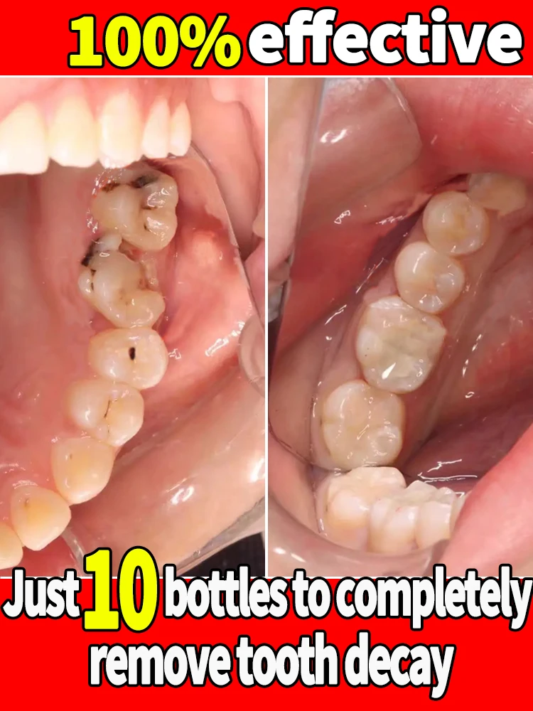 Teeth-whitening-anti-cavity-tooth-decay-fresh-bad-breath-repair-tooth ...