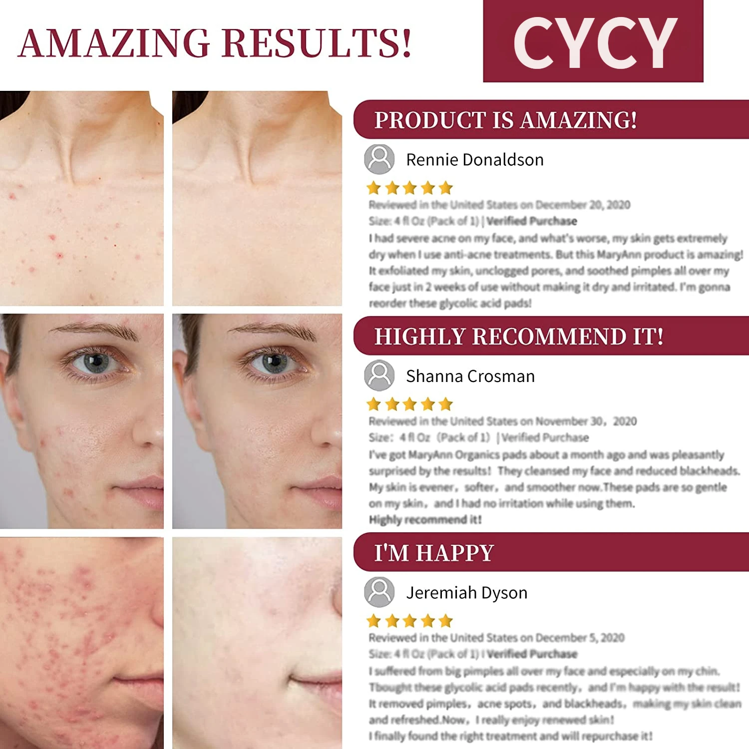 Lactic Acid Peel Acne