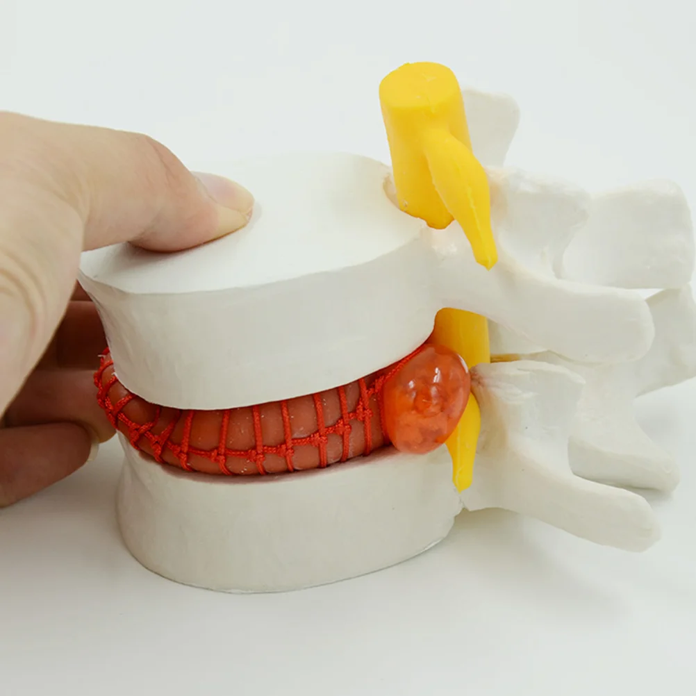 Lumbar Spine Model Lumbar Disc Herniation Spine Model - Magnification 1 ...