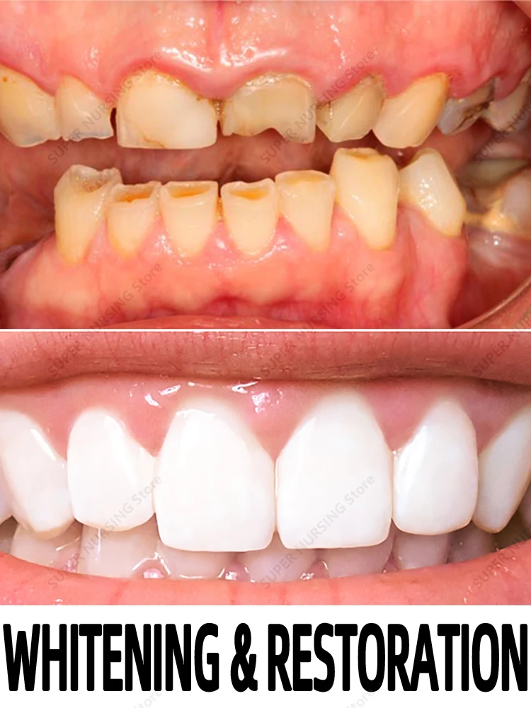 Yellow Teeth From Coffee
