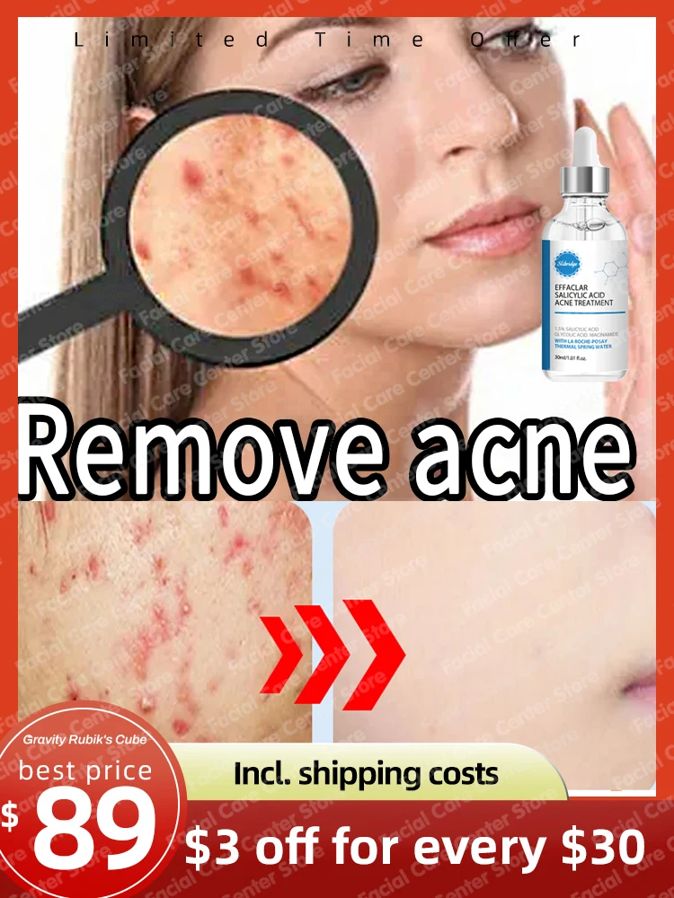 Anti-Acne-removedor-creme-espinhas.jpg