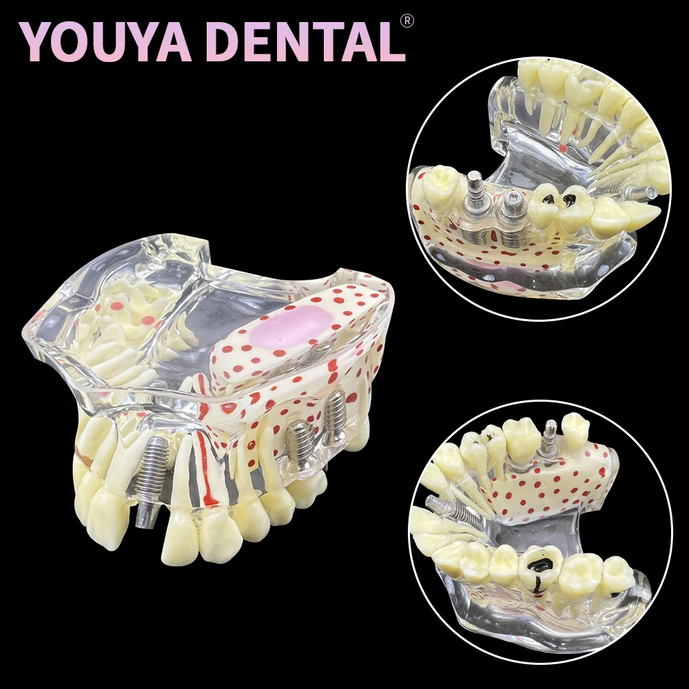 Dental-Implant-Model-Maxillary-Tooth-Model-With-Dental-Bridge-And ...