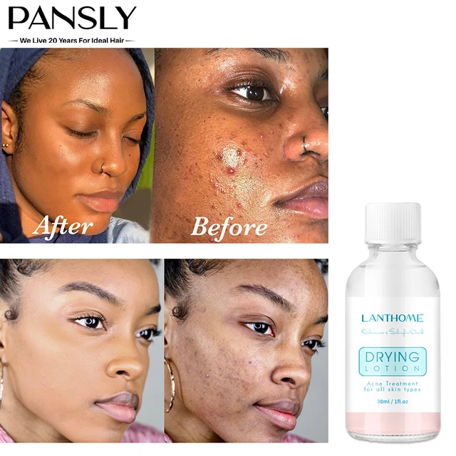 Kpop Acne Scars