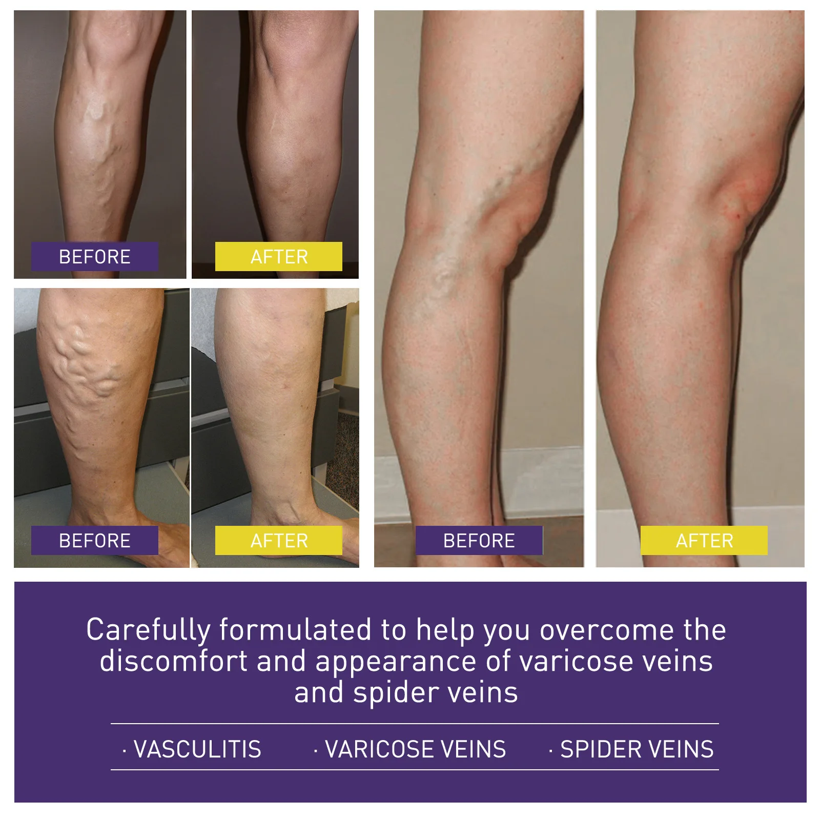 Ointment For Varicose Veins Effective Unblock Legs Phlebitis Vasculitis ...