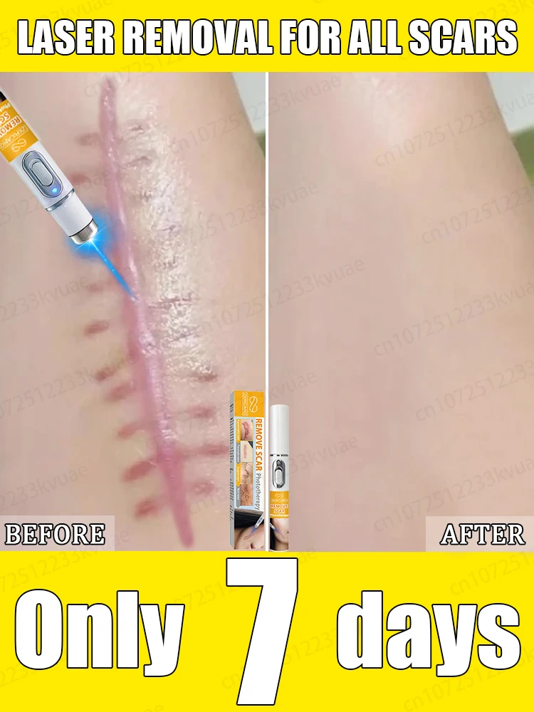 Laser Removal of All Scars: Real Before-and-After Results from My Own ...