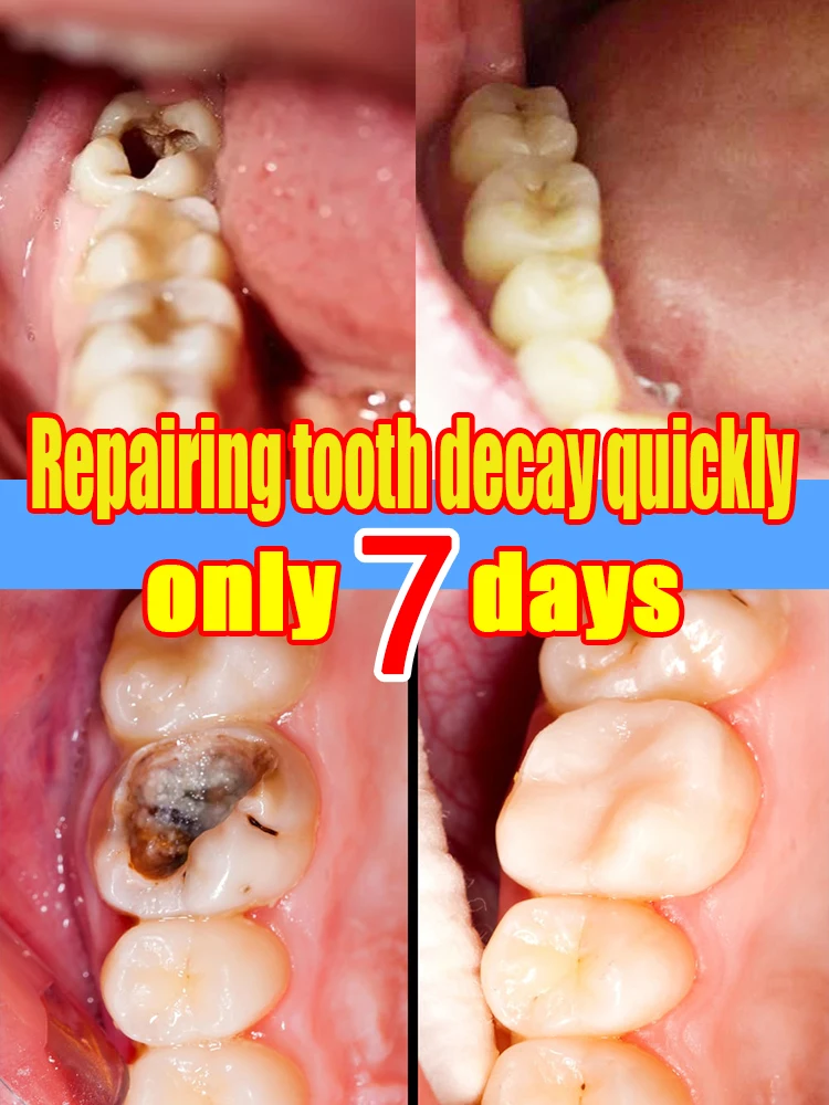 Anti-cavity-toothpaste-prevent-tooth-decay-protect-teeth-and-repair ...