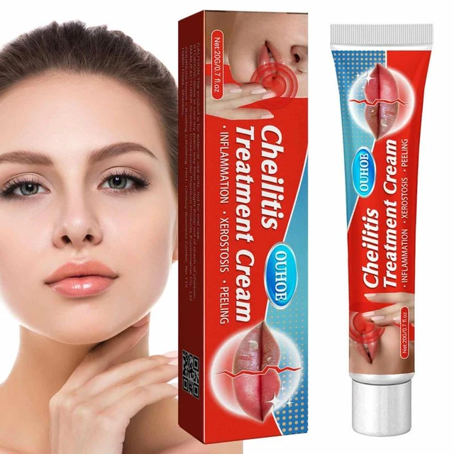 Ringworm Treatment Cream