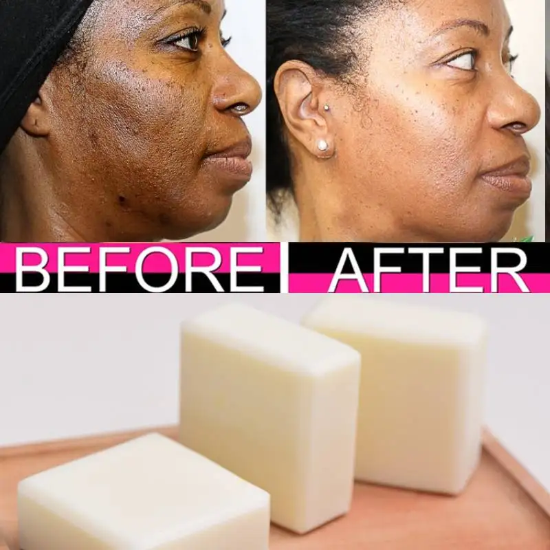 Glutathione Soap Before And After