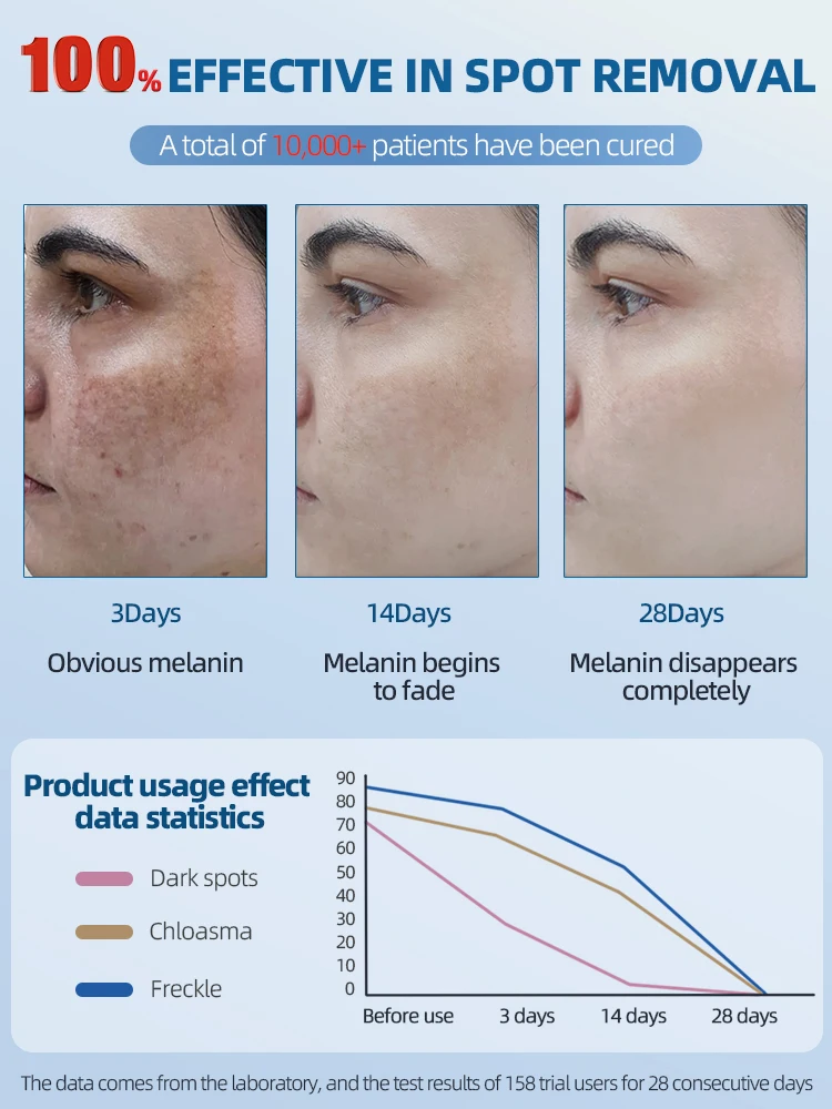 SLIBRIDGE freckle remover cream remove from pigmentation on the face ...