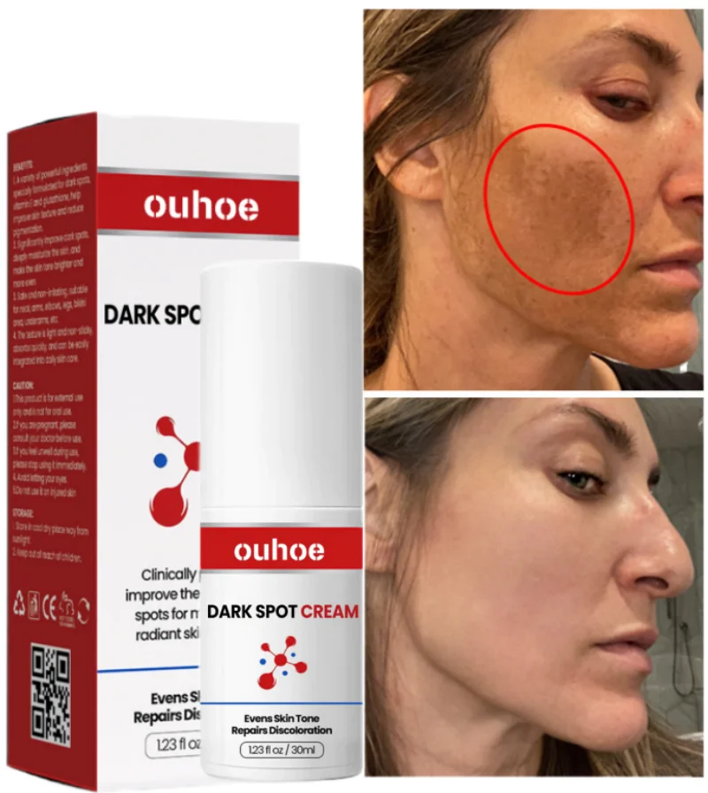 Powerful-Dark-Spot-Removal-Cream-Whiten-Body-Lotion-Lightening-Melanin ...