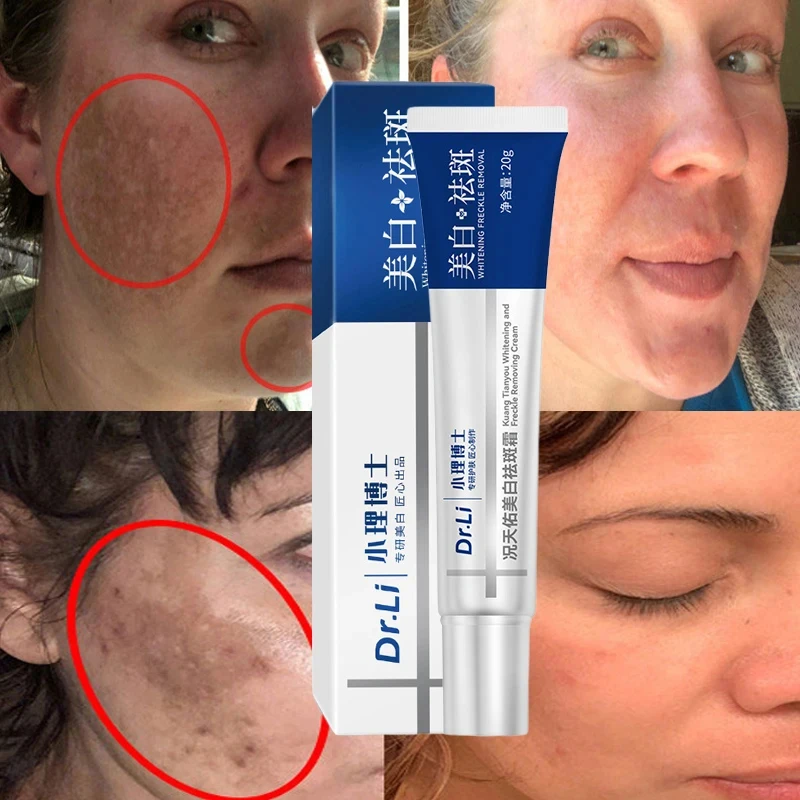Face-Dark-Spots-Remover-Effective-Whitening-Remove-Melasma-Freckles ...