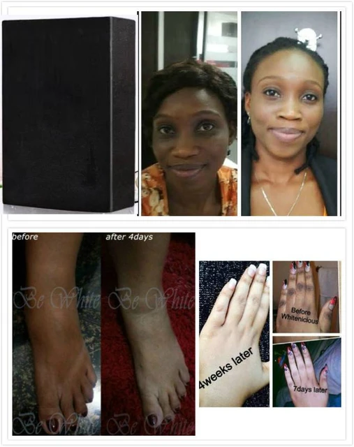 Whitenicious Before And After Pictures