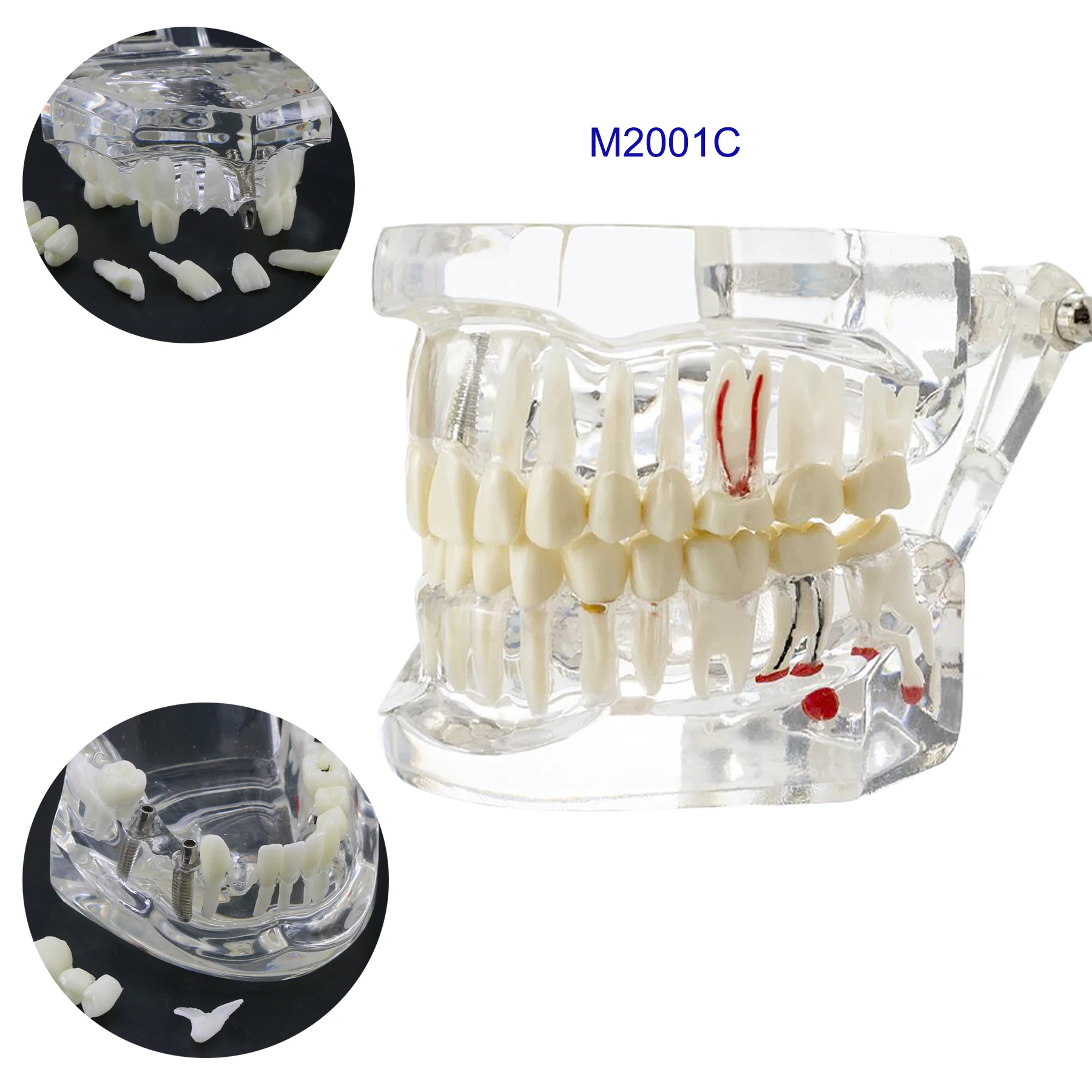Dental-Model-Transparent-Implant-Disease-Teeth-Repair-Teeth-Model ...