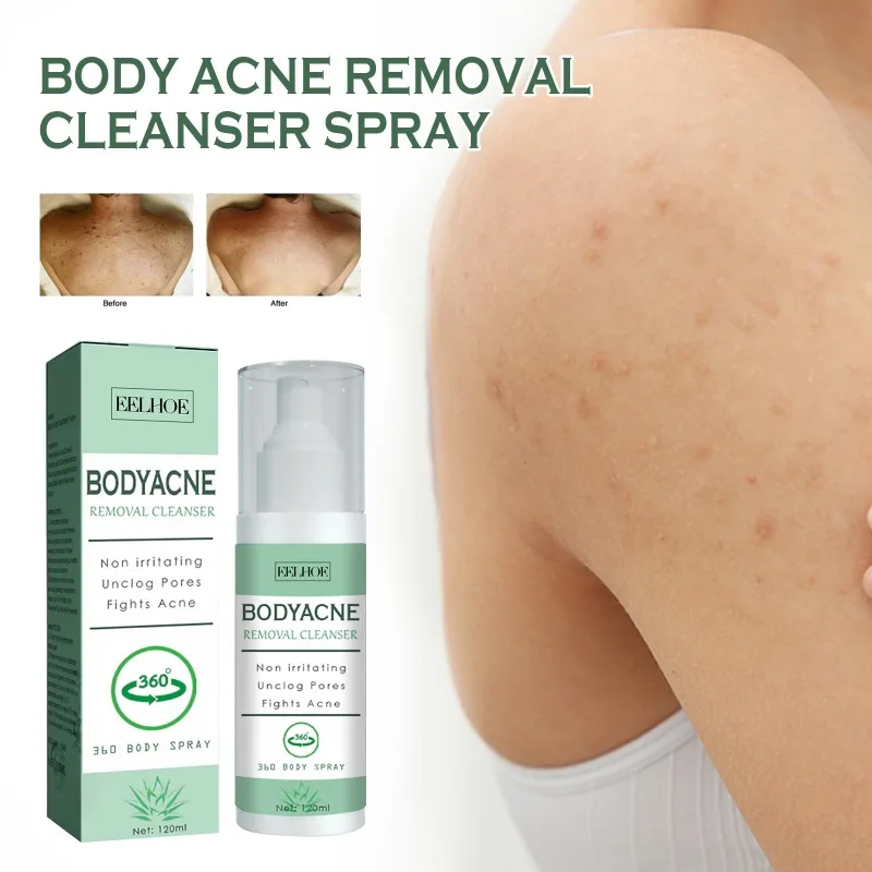 Back-Acne-Treatment-Spray-Lighten-Back-Acne-Mark-Repair-Shoulder-Acne ...