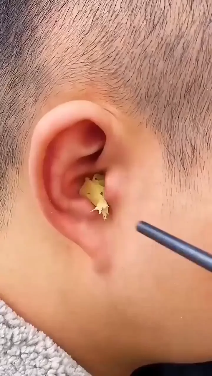 6pcs/set Earwax Removal, Integrated 360 Degree Rotating Stainless Steel ...