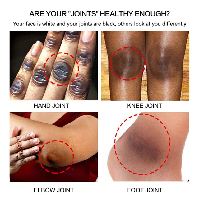 Bruised Black Knuckles
