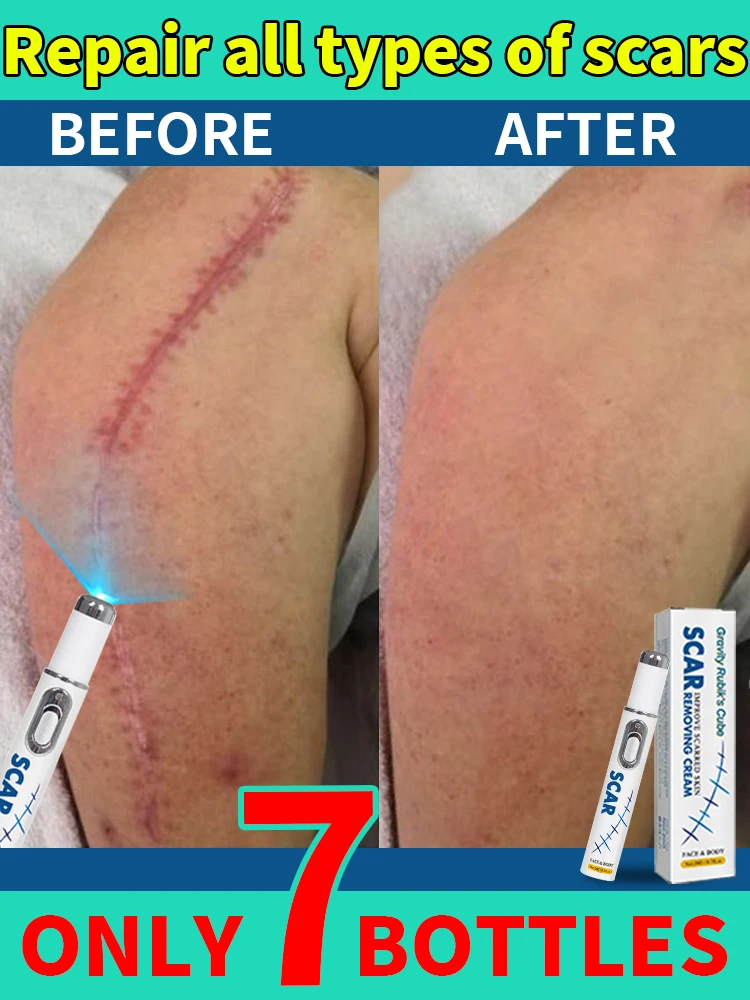 Laser-whitening-for-Repair-Scars.jpg