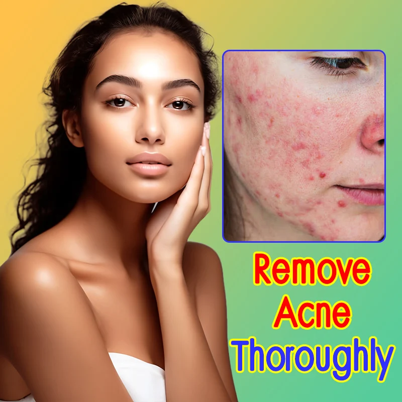 Acne-Removal-Inhibit-Acne-Growth-Repair-Facial-Skin-Herbal-Acne-Cream ...