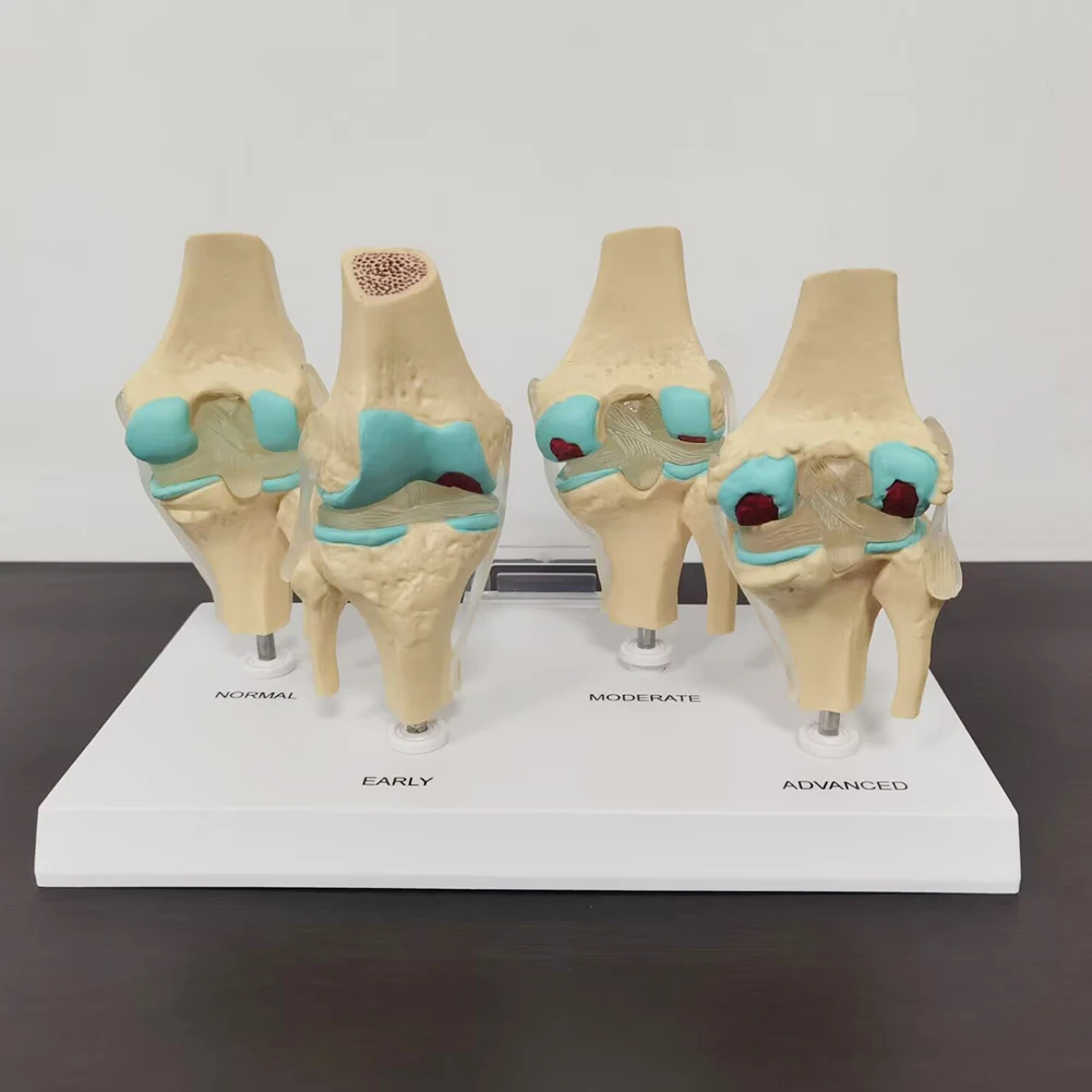 4-stage-knee-joint-model-Plastic-Bone-Model-Of-Human-Body-Teaching ...