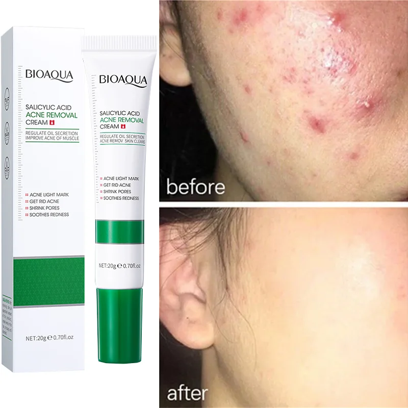 Salicylic Acid Acne Removal Cream Effective Acne Treatment Remove Blackheads Acne Oil Control ...