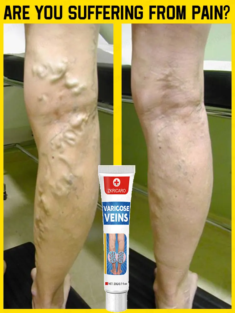 The-Most-Popular-Products-for-Varicose-Vein-Treatment.jpg