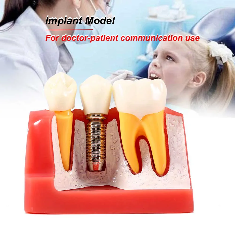 4-Times-Dental-Teaching-Model-Implant-Analysis-Crown-Bridge ...