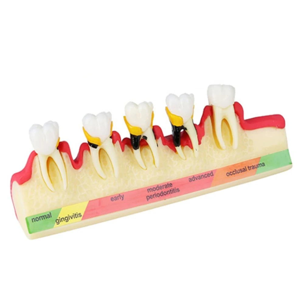 Dental-Periodontal-Disease-Classification-Model-Dentistry-Education ...
