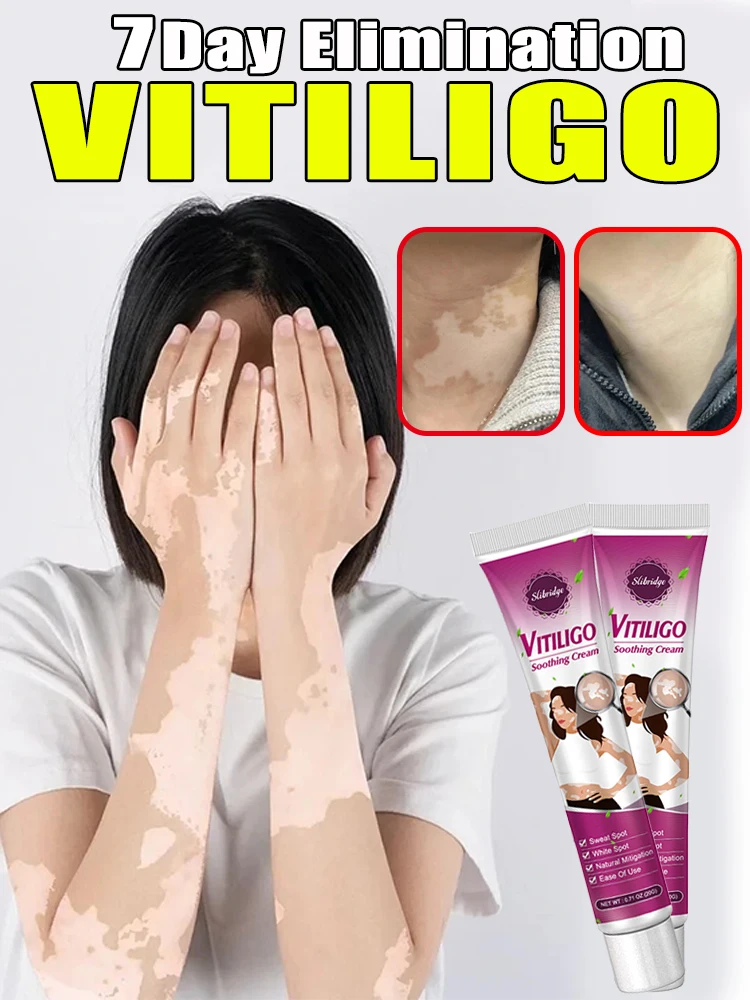 NewVitiligo-Ointment-Effectively-Remove-White-Spot-Removal-Body-Skin ...