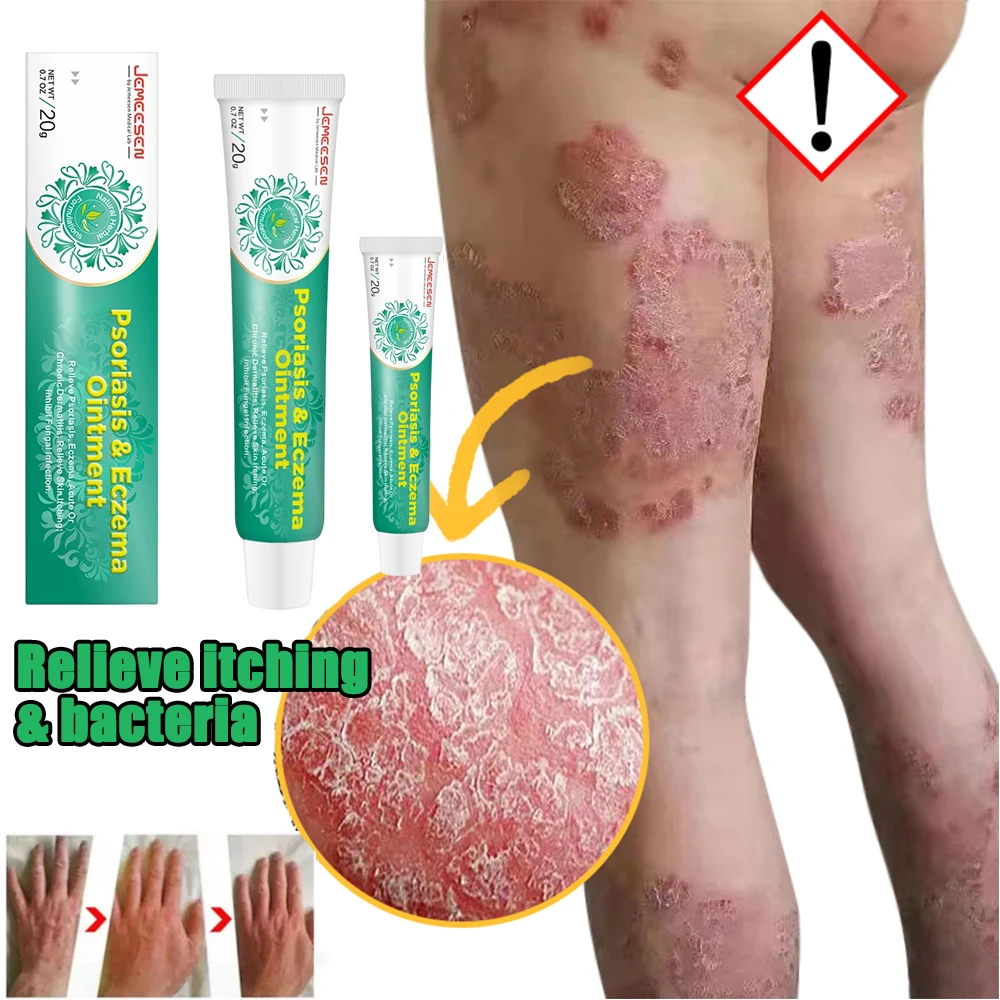 Psoriasis Cream Scrotum Itching Rash Dermatitis Eczema Treatment Herbal Psoriasis Cream Scrotum Itching Rash Dermatitis Eczema Treatment Herbal