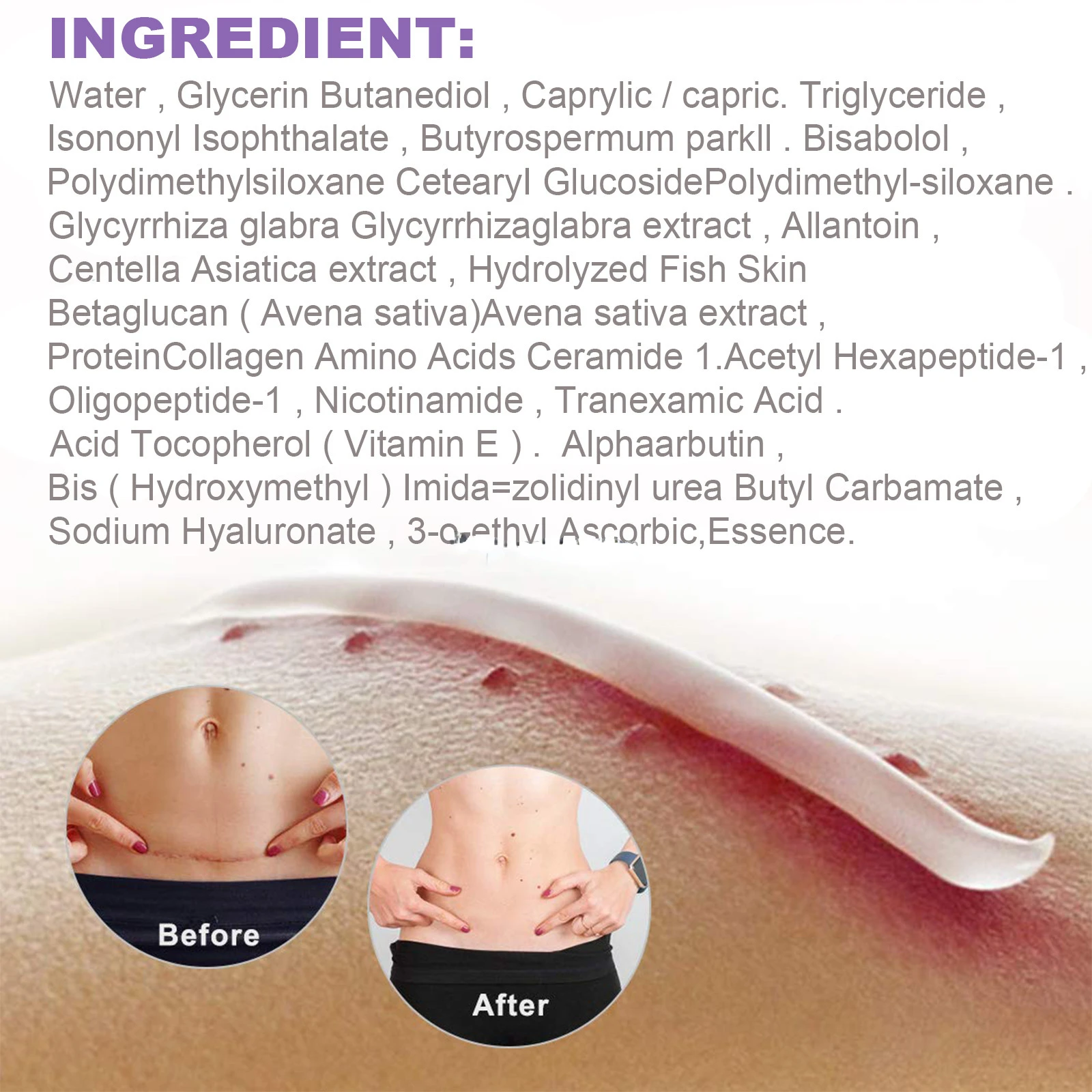Acne Surgical Stretch Marks Removal Scar Cream Pimples Face Gel Child ...