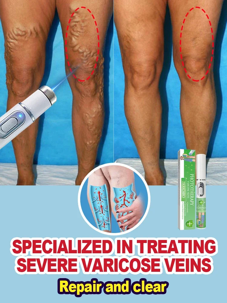 Laser-therapy-can-improve-medium-intensity-varicose-veins-effectively ...