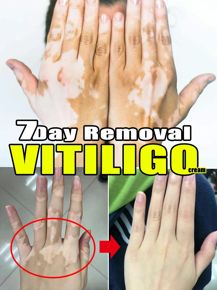 NewVitiligo-Ointment-Effectively-Remove-White-Spot-Removal-Body-Skin ...