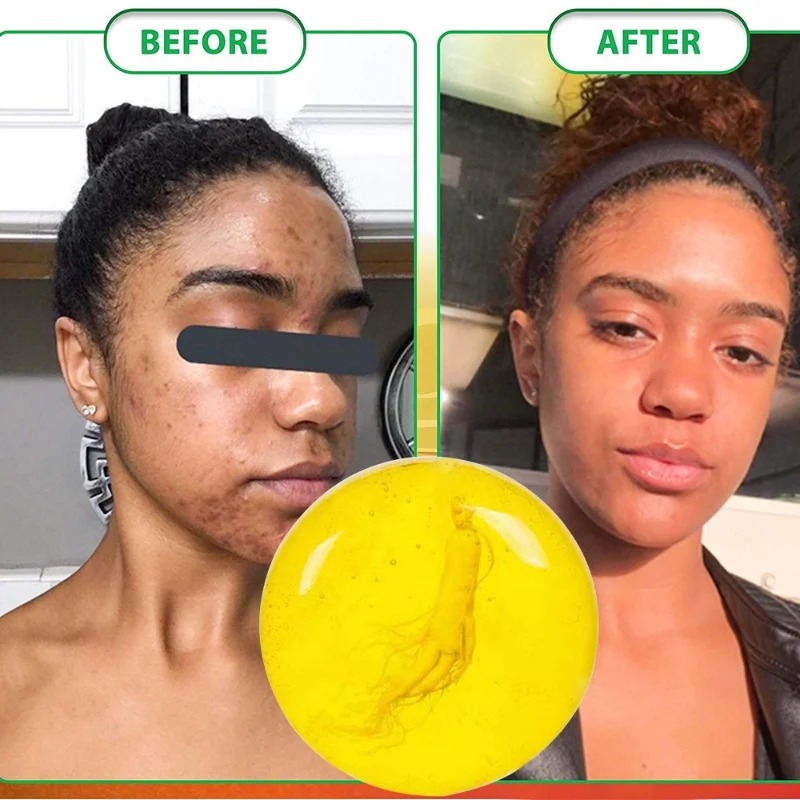 Acne Scars Before And After Lemon
