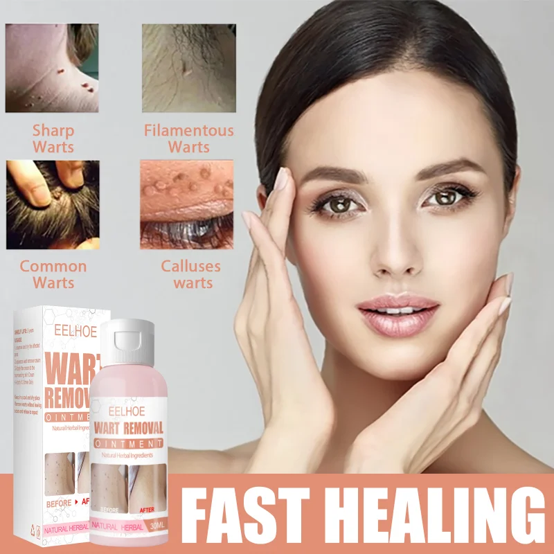 Filiform Wart On Face