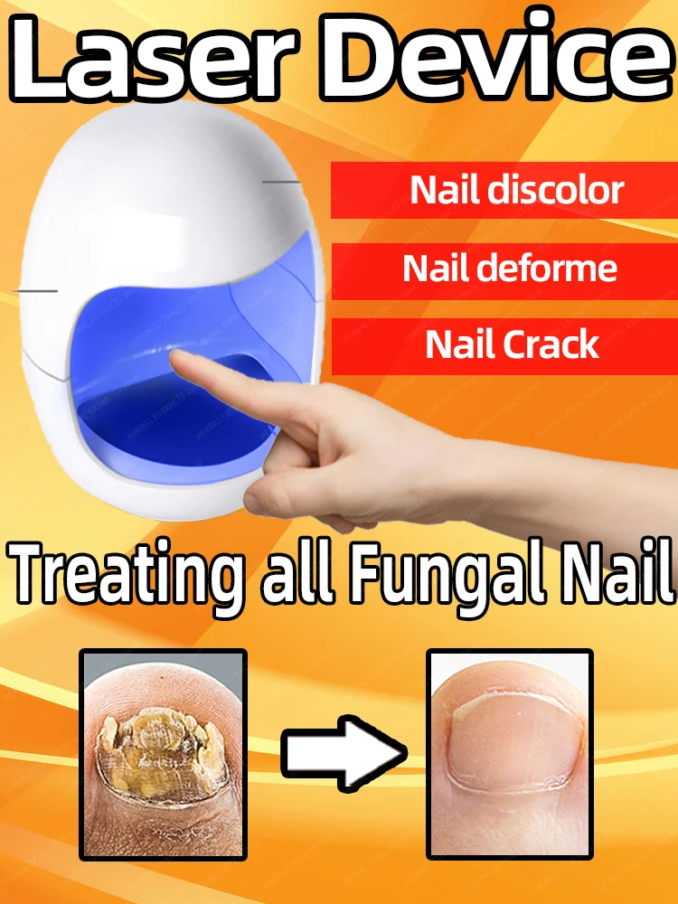 Fungal-Nail-Laser-Onychomycosis-Fungus-Nails-Repair-Fast.jpg
