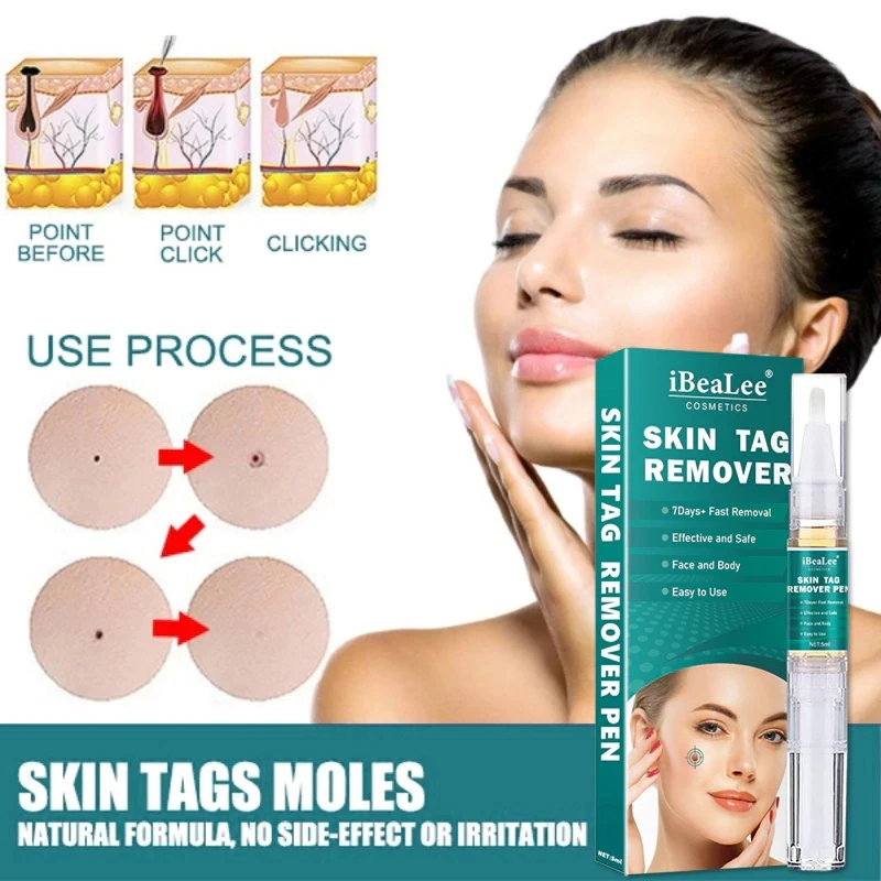 iBeaLee Skin Tag Remover Pen Painless Fast Dark Spot Mole Warts Removal ...