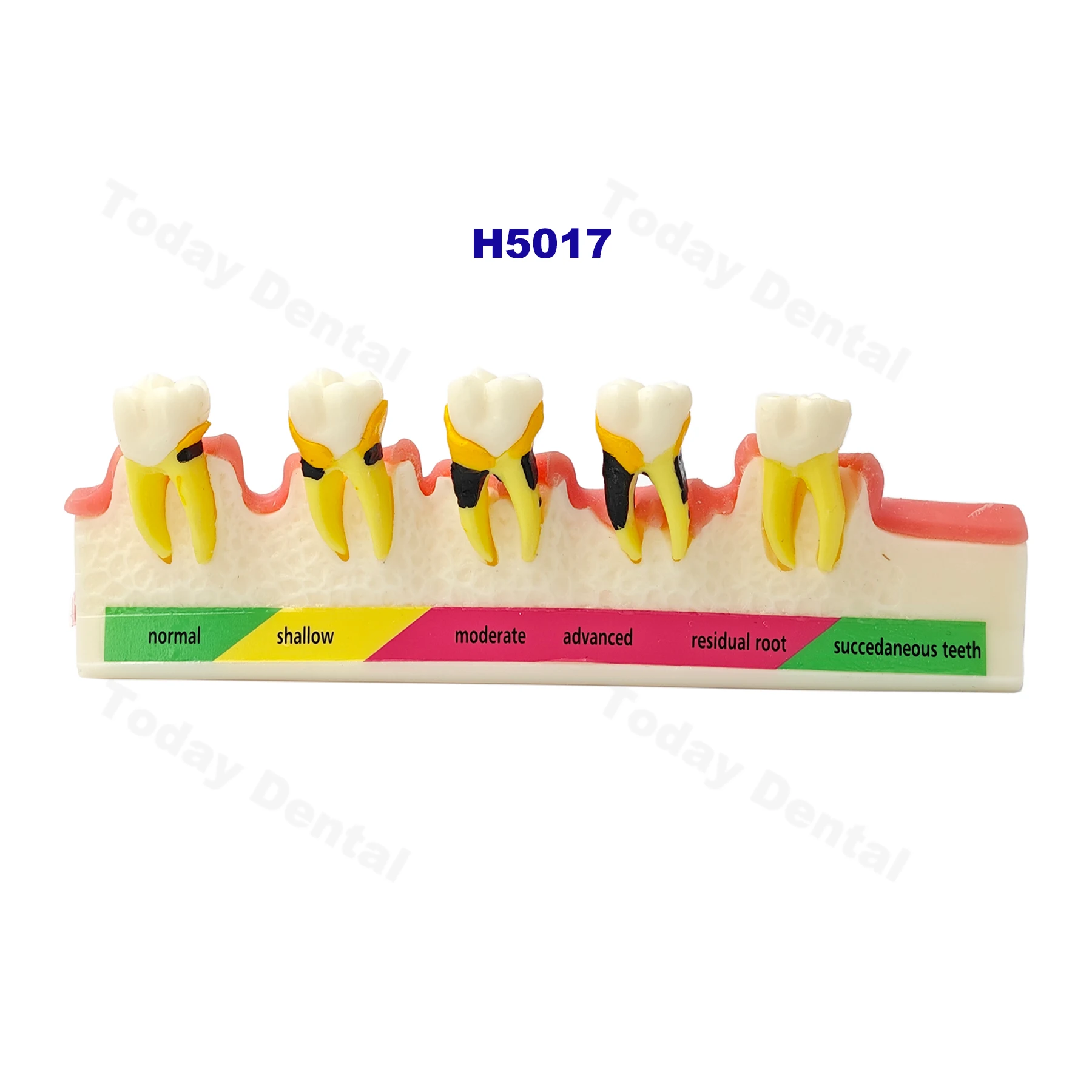 Dental-Pathological-Typodont-Teeth-Model-5-Stages-Periodontal-Disease ...