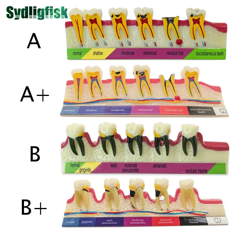Dental-Model-Teeth-Periodontal-Disease-Model-Assort-Demo-Caries-Model ...